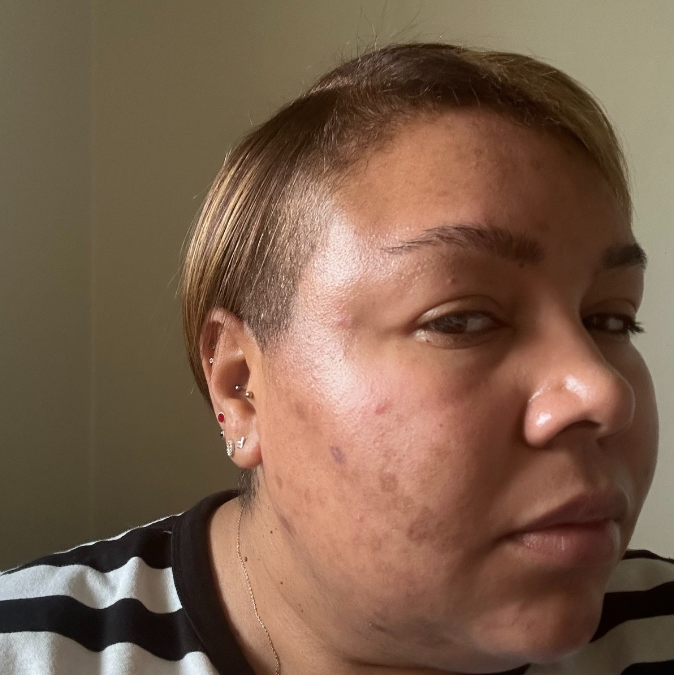 hyperpigmentation - uncouth